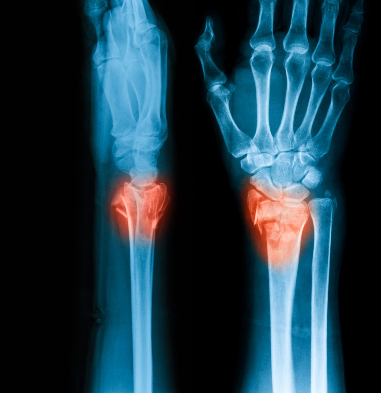 Anabolic treatment of osteoporosis in 2020 - deNovo Medica