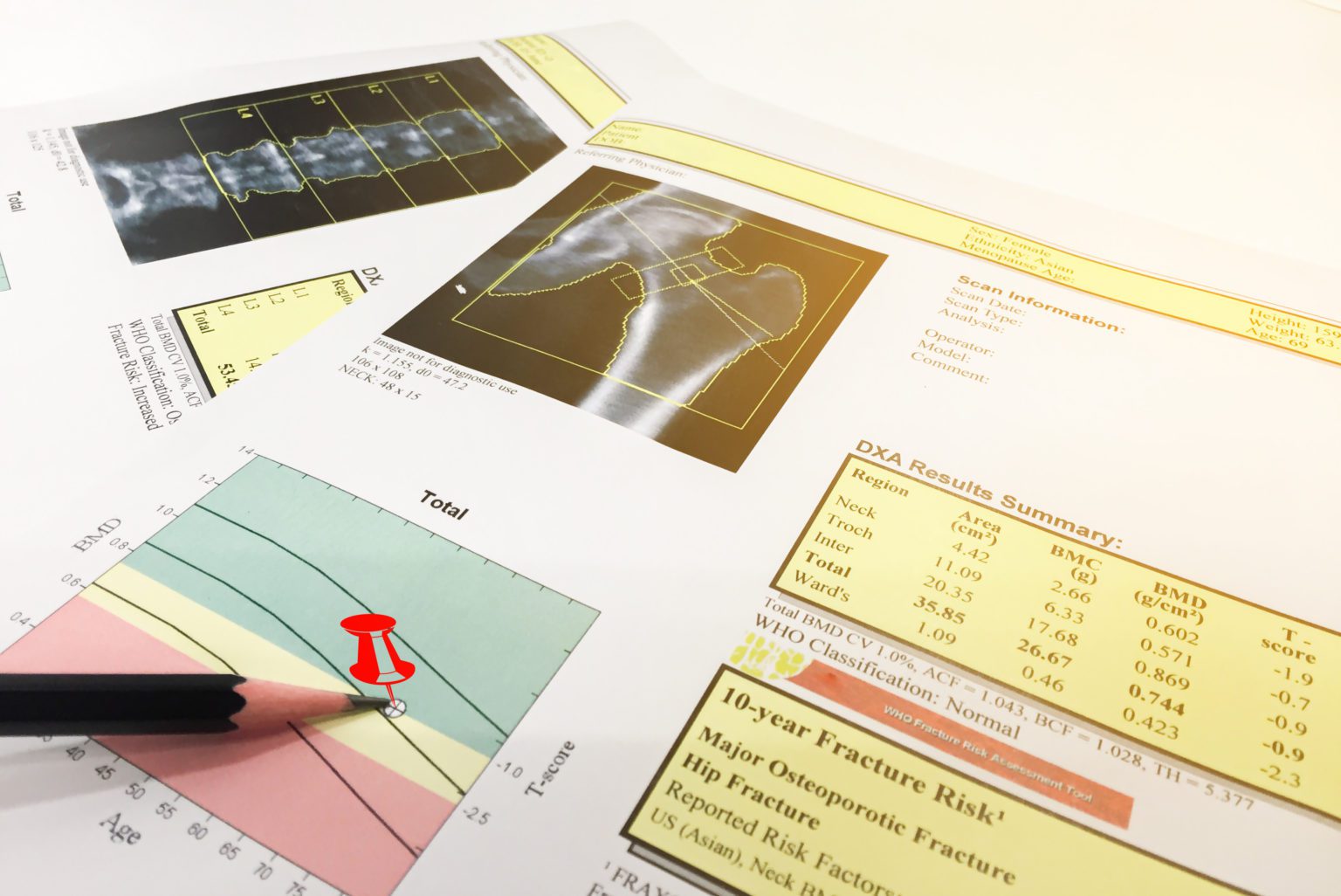 The FRAX tool – how to predict fracture risk in South African patients ...