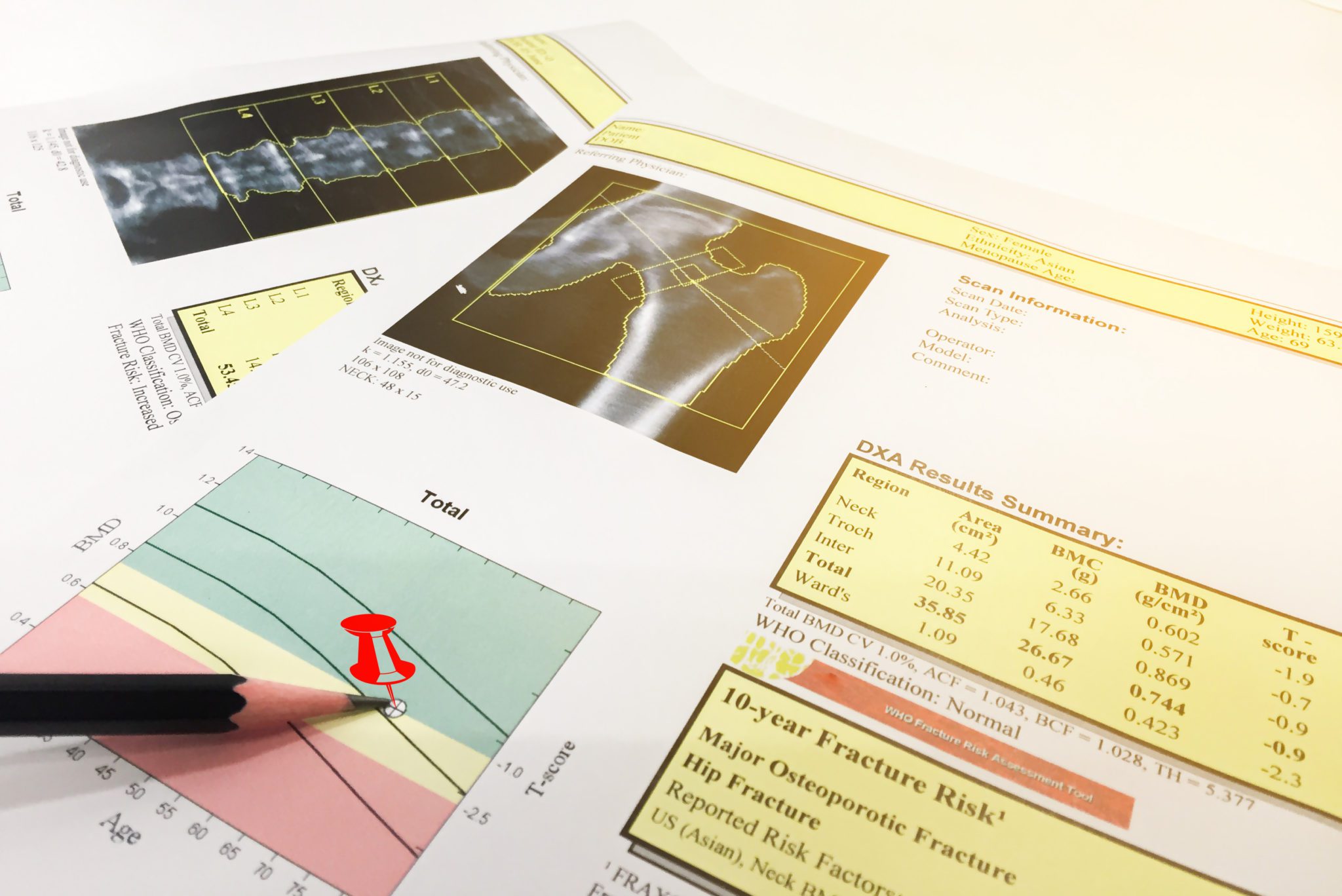 The FRAX tool – how to predict fracture risk in South African patients ...